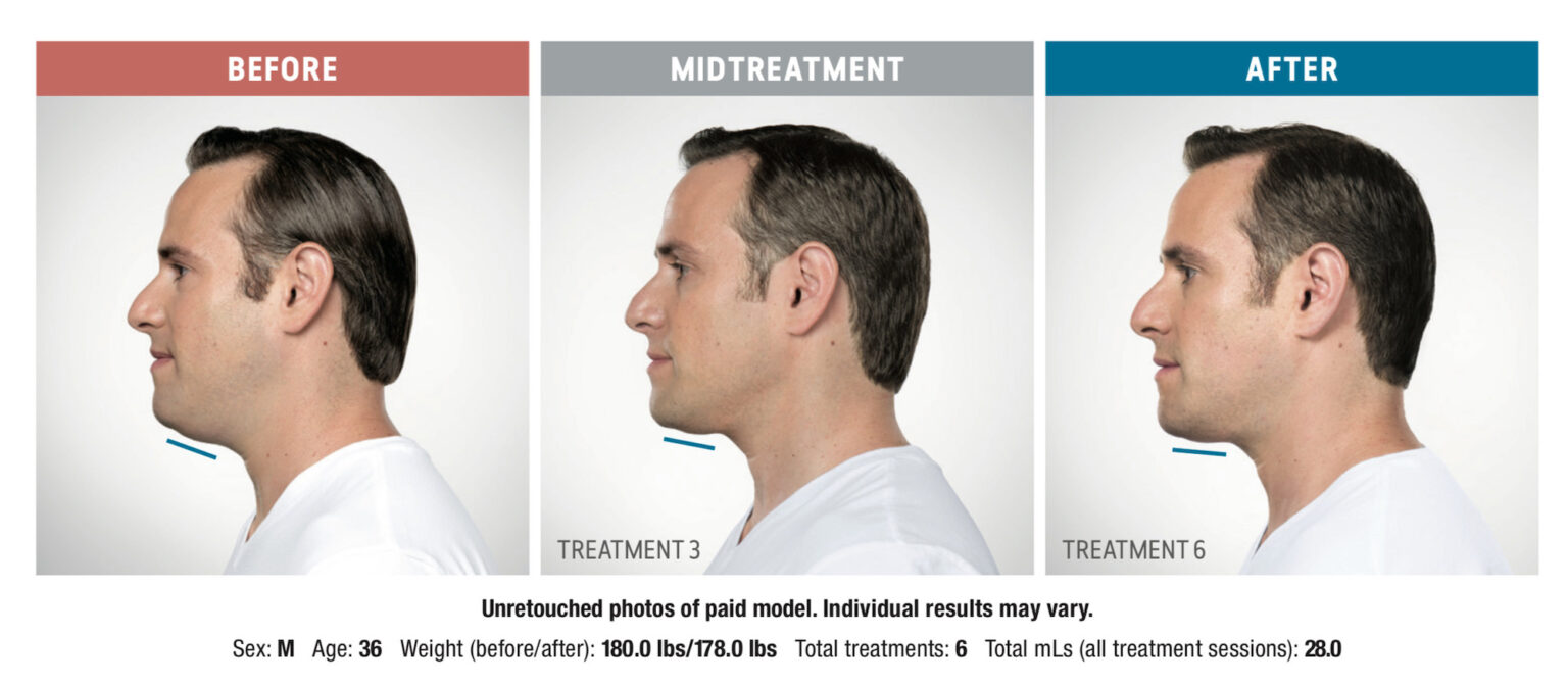 Kybella in Lebanon | Restoration Wellness and Medspa