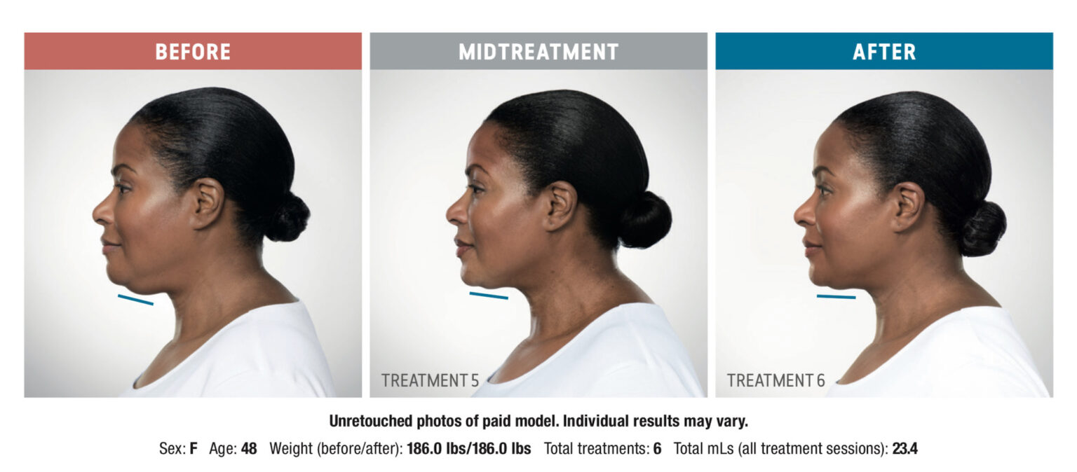 Kybella 2 - Restoration Wellness and Medspa