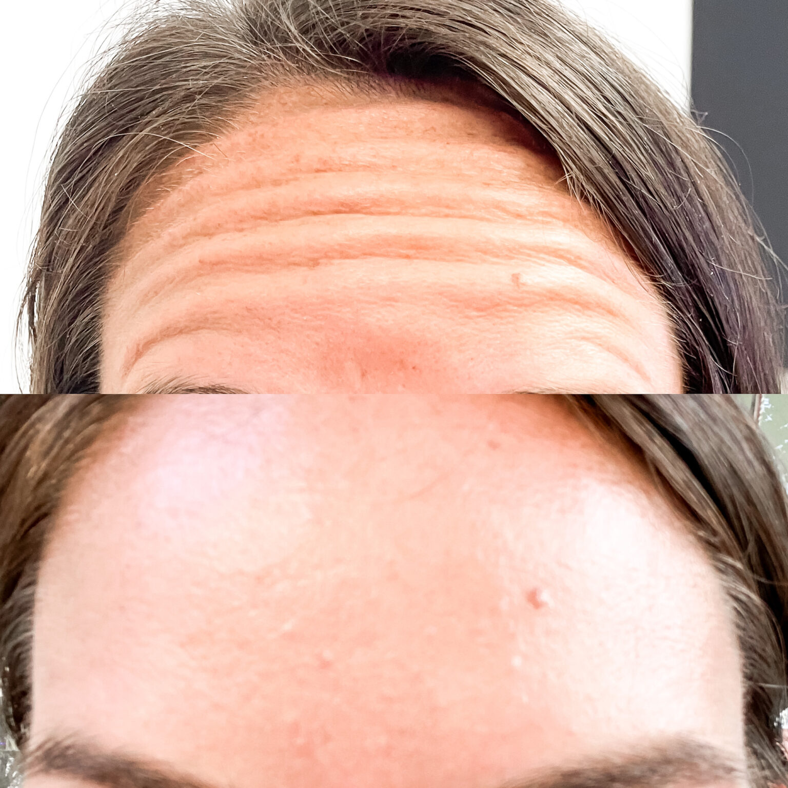 Botox in Lebanon, TN | Restoration Wellness and Medspa